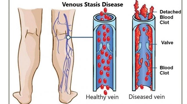 What Is Venous Stasis Disease: Are You Affected And What It Means ...